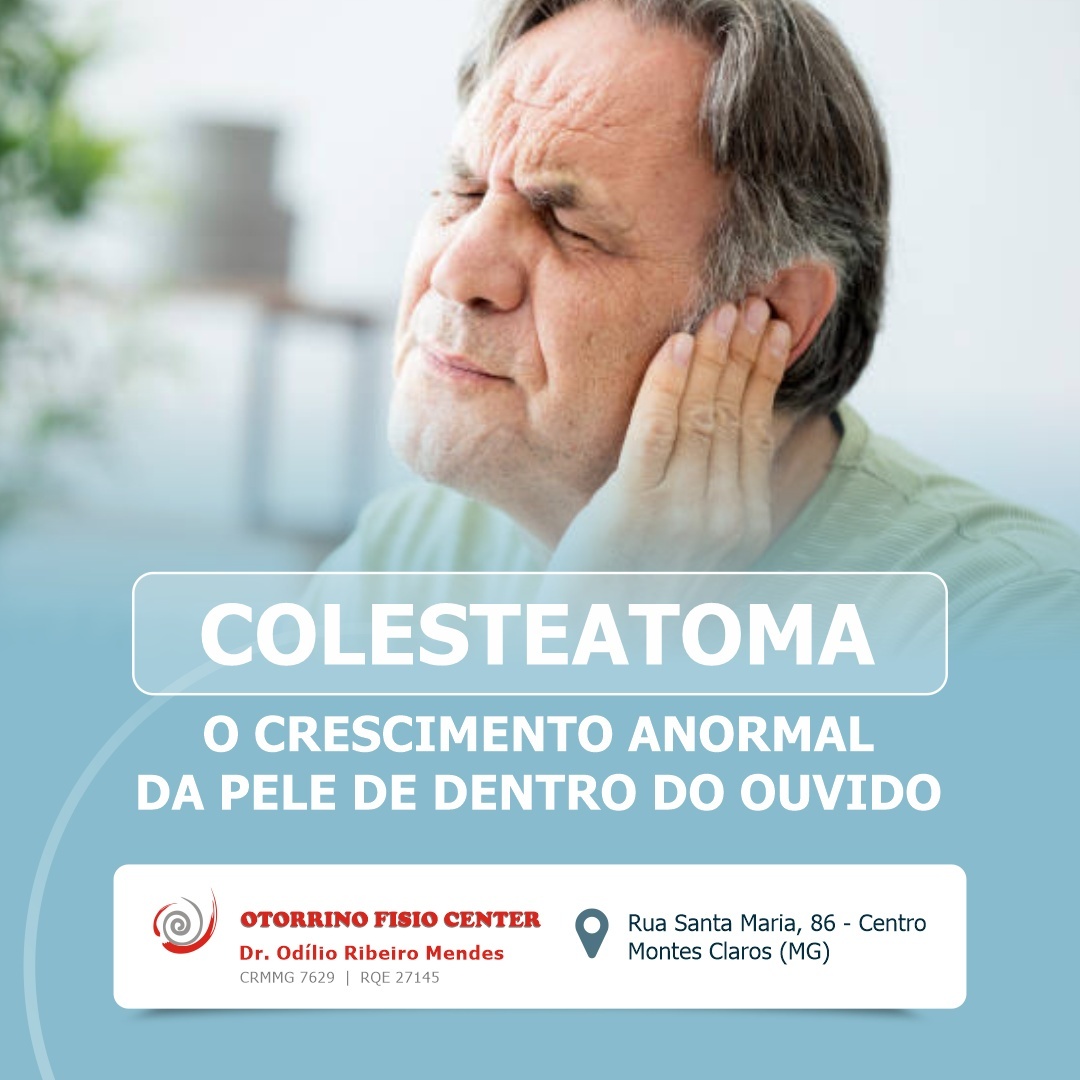 Colesteatoma - Otorrino Fisio Center
